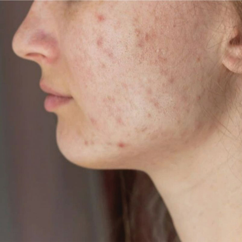 Living with Pcos ( Road to Reversal ) - HARDCOVER BOOK – PCOS With Candice